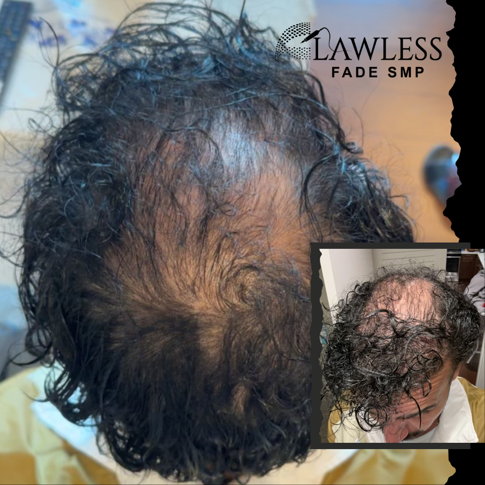 HAIRLINE RESTORATION - Flawless Fade SMP