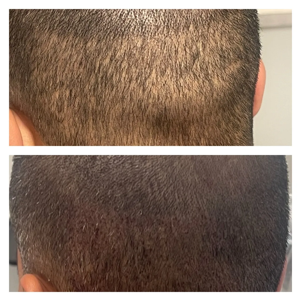 What are Emerging Trends in Scalp Micropigmentation for 2025 ...